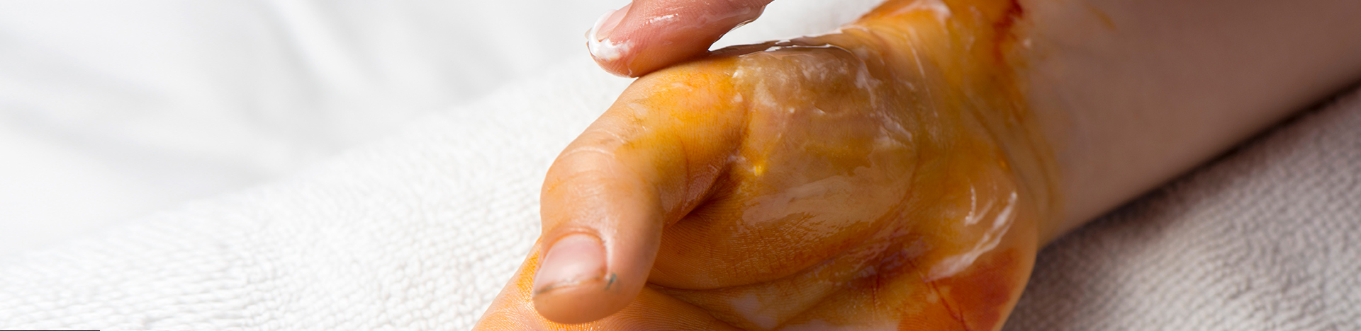 Brunswick Burn Injury Lawyers - Roden Law